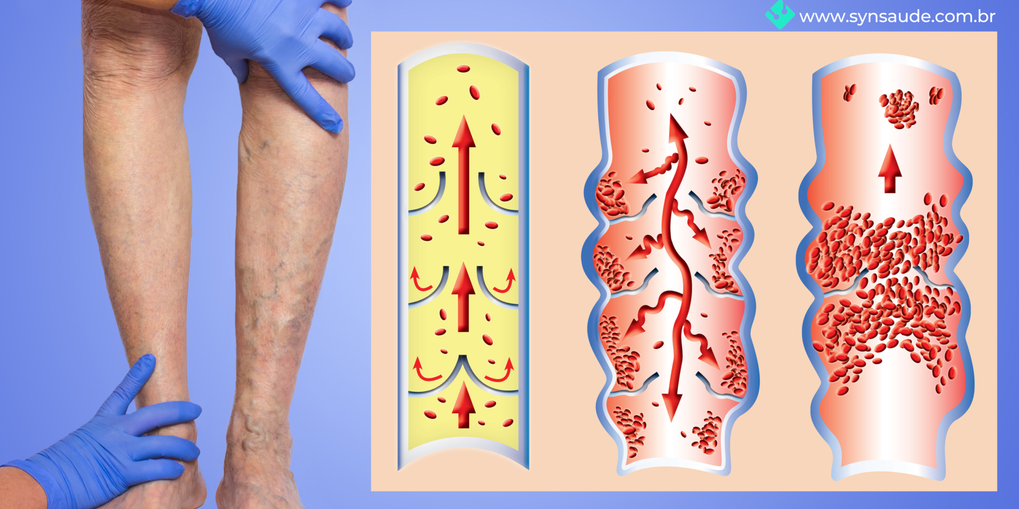 Cirurgia causa trombose? Leia o artigo e saiba a resposta